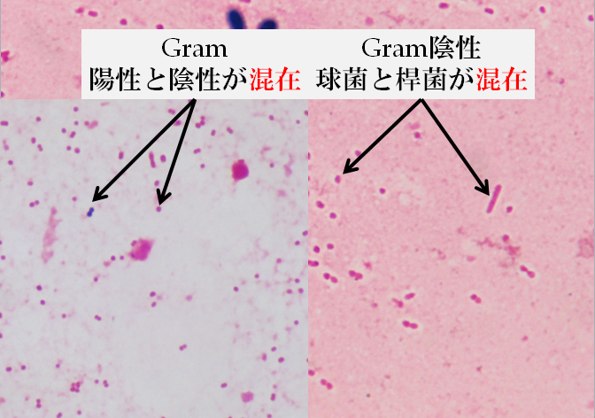 Acinetobacter baumannii肺炎 〔劇症型市中肺炎〕 | グラム染色: Gram Stain